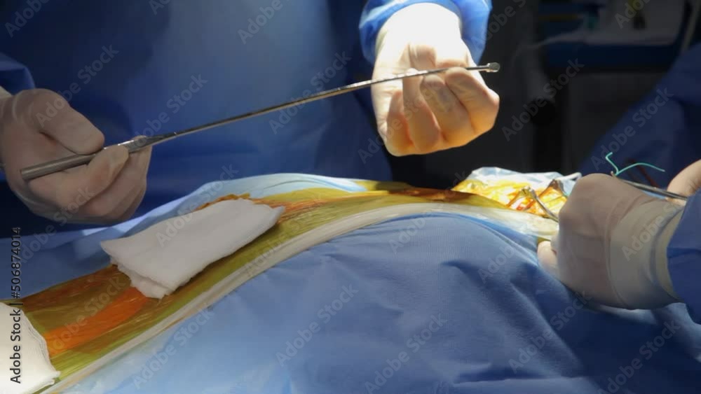 The neurosurgeon performs ventriculo-peritoneal shunting. Shunt medical ...