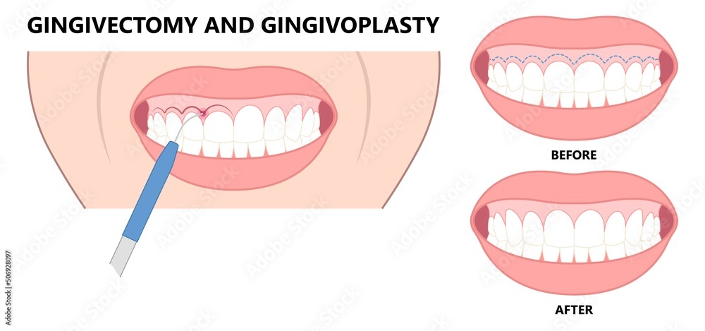 Gingivectomy gum graft smile small teeth deep cleaning prep flap dental ...