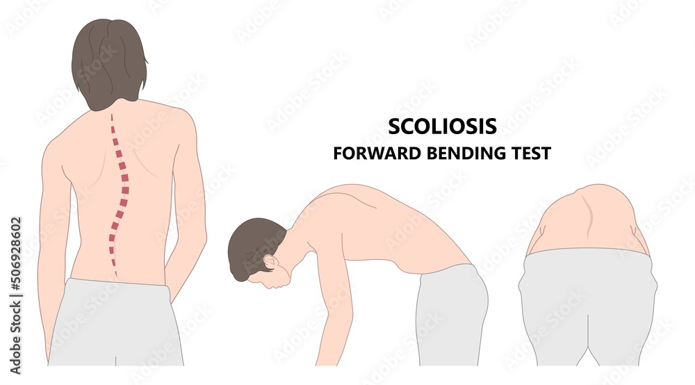 spine forward head posture chest xray neck pain lumbar Scheuermann's ...