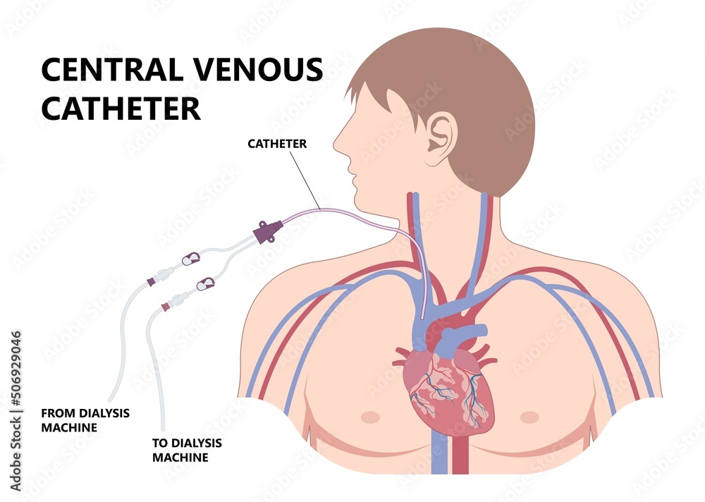 Vascular access for kidney graft shunt lumen with PICC line tube chest care artery vein arm ...