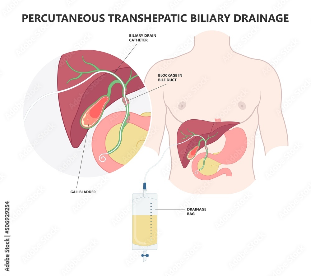 stent acute guided with ERCP and ERGD drain surgical laparoscopy tube bile duct stone bag liver ...