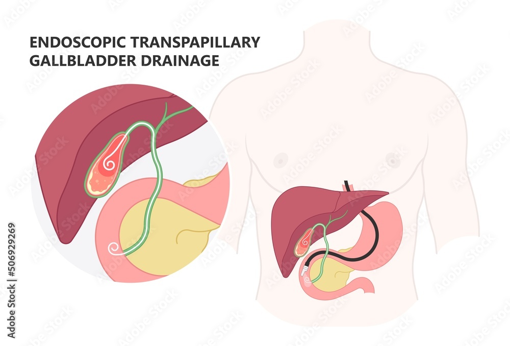 stent acute guided with ERCP and ERGD drain surgical laparoscopy tube ...