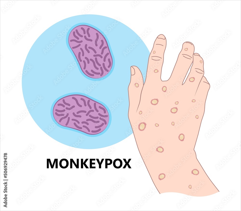 Monkeypox virus genus rash spots body skin Scabs zoonoses sick ...
