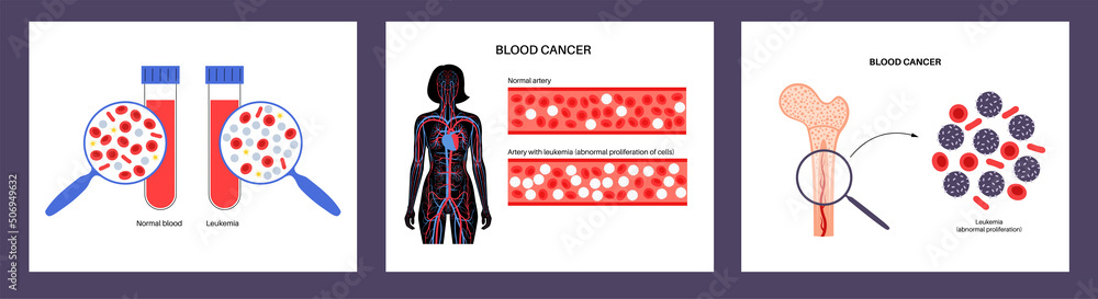 Poster leukemia blood cancer – Wall Art | UkPosters