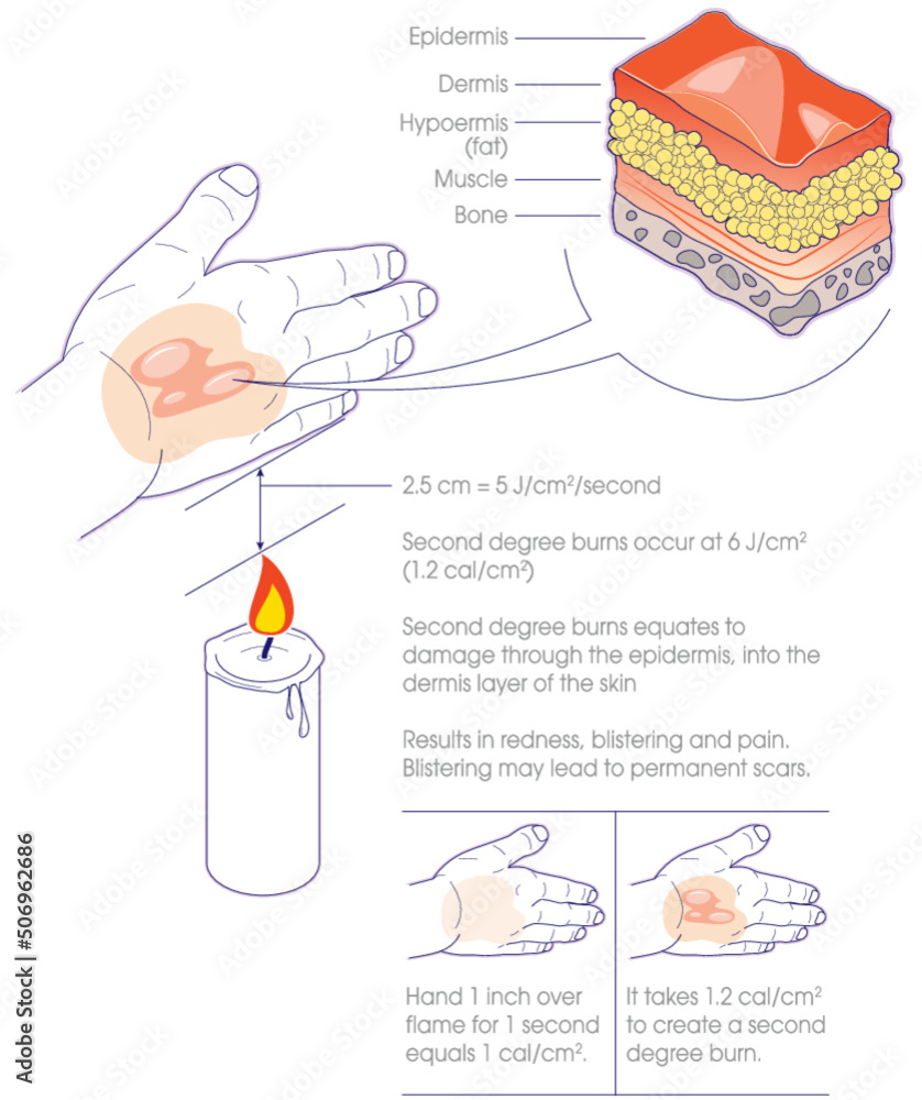 Second Degree Burns Infographic Explained on Hand with cross-section of ...