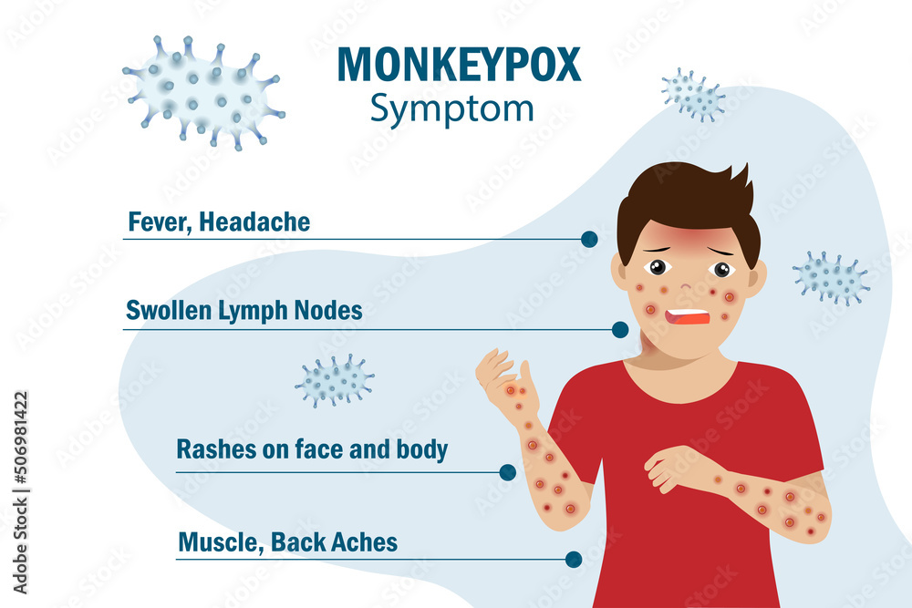 Monkeypox virus symptom infographic on patient with fever, headache ...