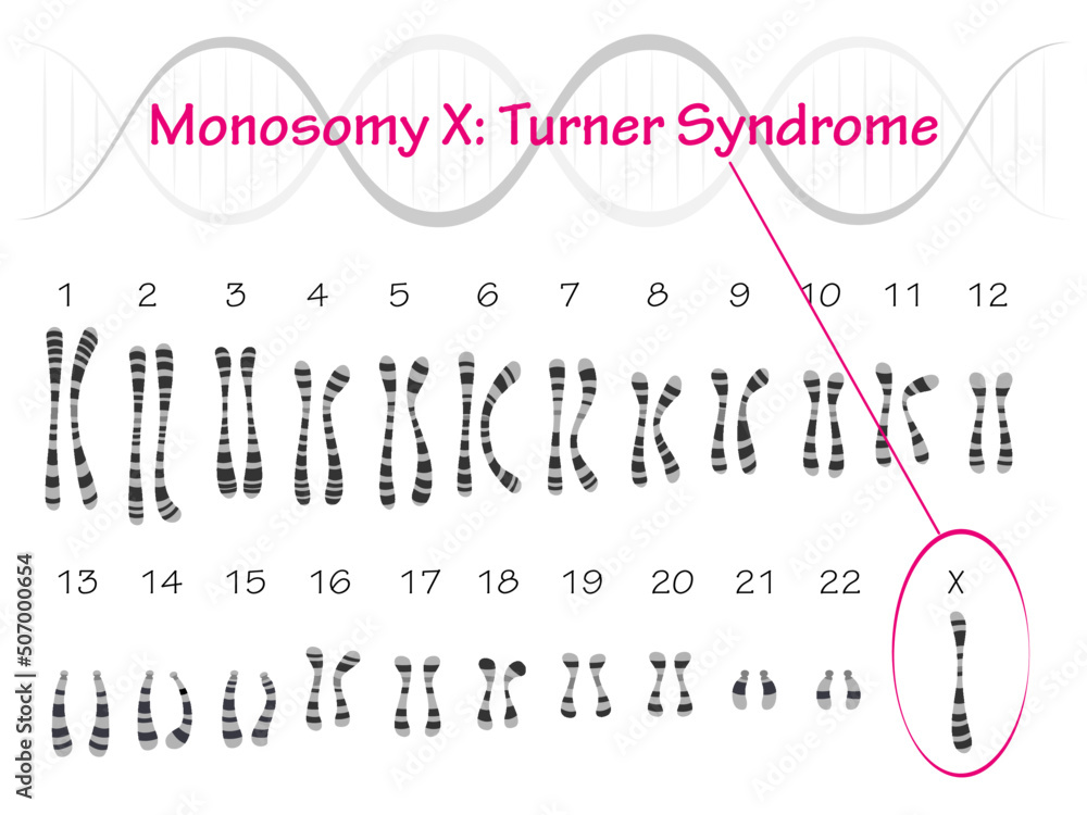 Monosomy 13