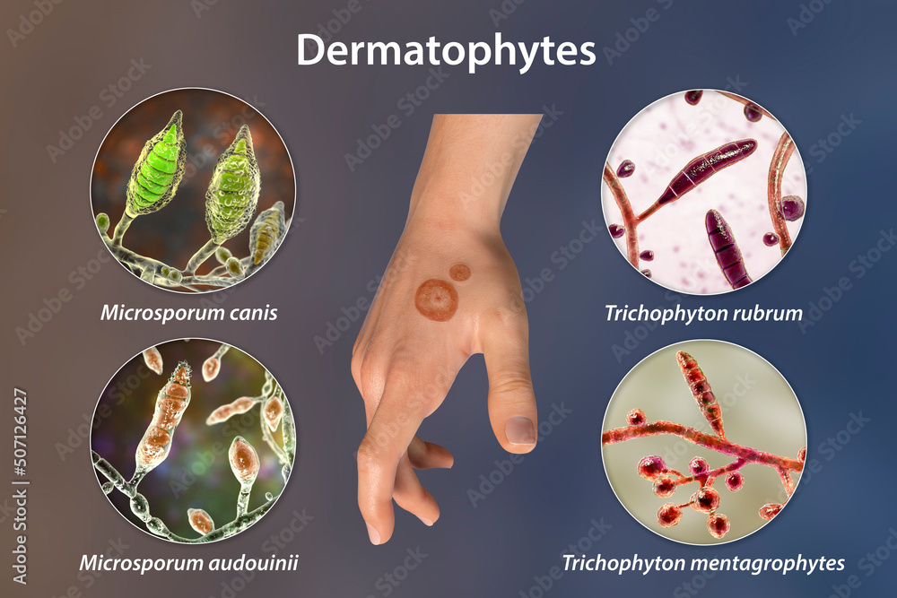 Hand fungal infection, tinea manuum, 3D illustration Stock Illustration ...