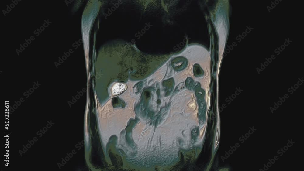 Bulk multicolored CT scan of the abdomen. Computed tomography of the ...