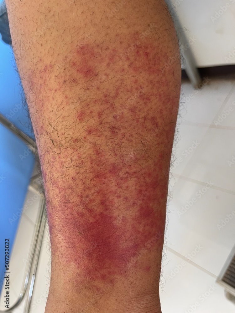 Diabetes foot Infected wound of medical dressing wound infection ...