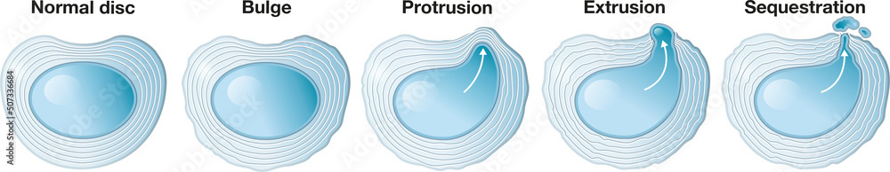 Herniated disc schema. Normal disc. Bulge. Protusion. Extrusion ...