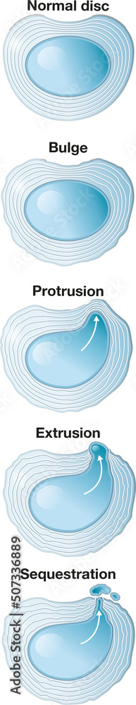 Herniated disc schema. Normal disc. Bulge. Protusion. Extrusion ...
