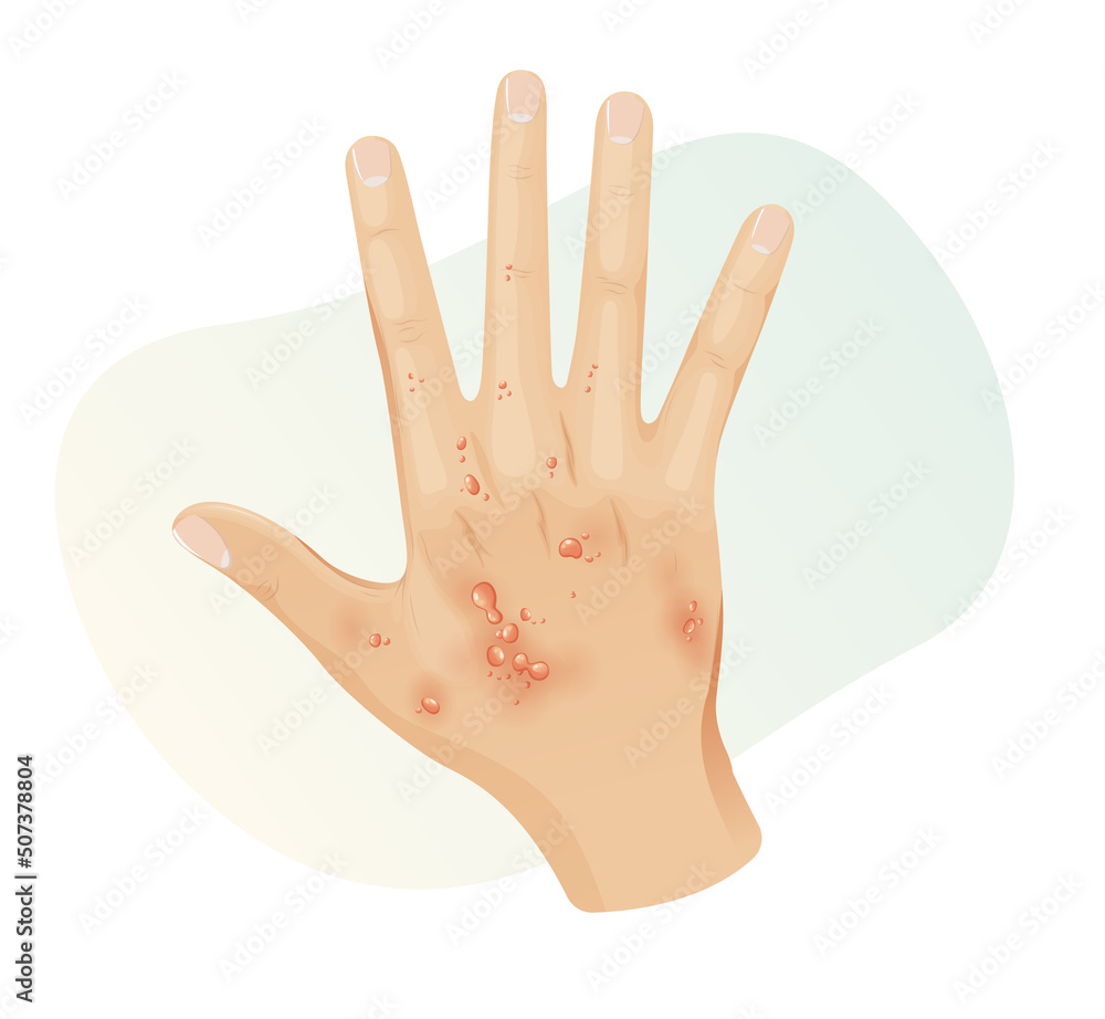 Monkeypox - Skin Rashes and Spots as Symptoms - Icon Stock Vector ...