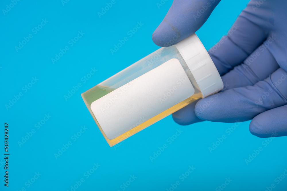 container with a urine sample for microbiological laboratory analysis ...