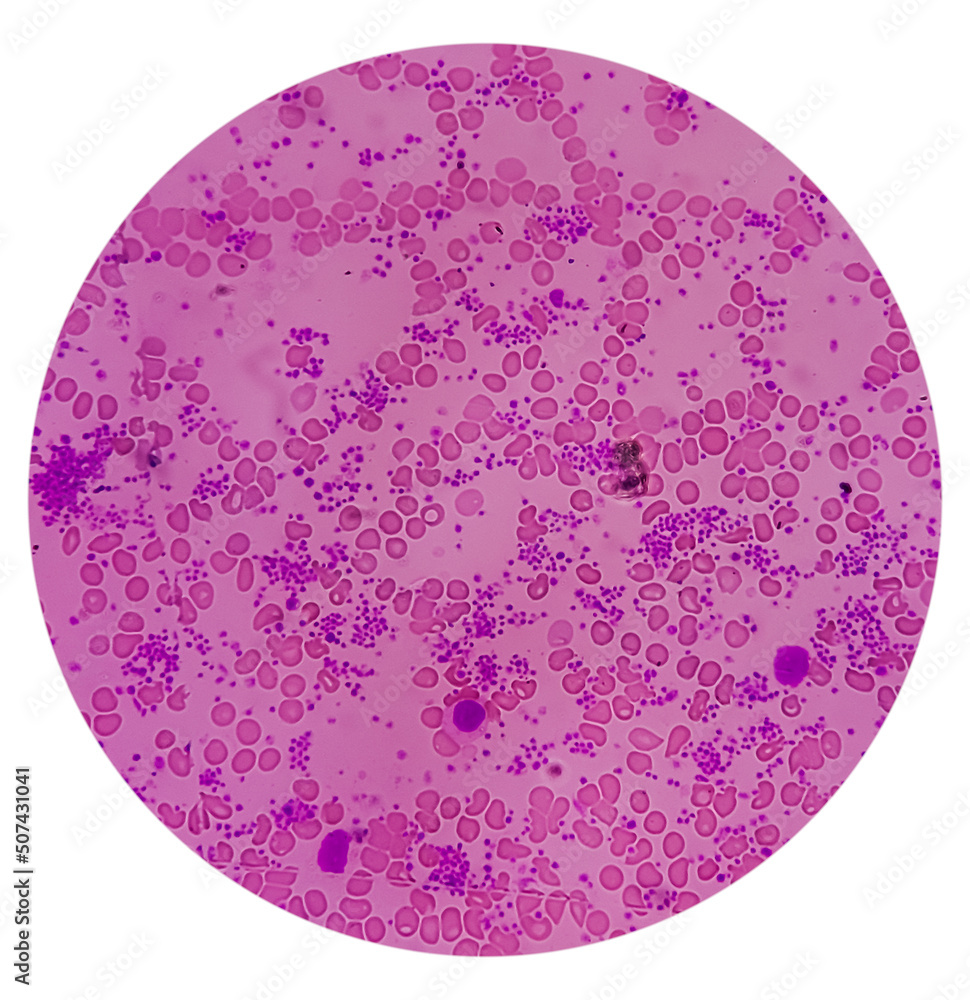 Foto de Thrombocythemia, Essential thrombocytosis blood smear, present ...