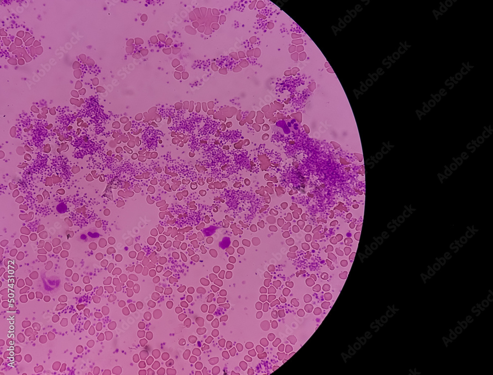 Thrombocythemia, Essential thrombocytosis blood smear, present abnormal ...