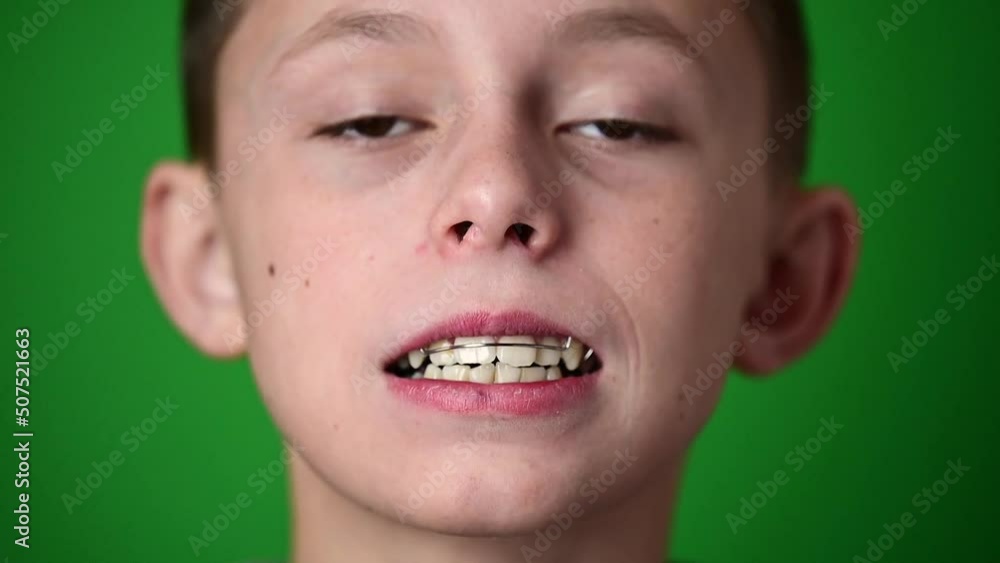 Dental plate for aligning teeth in the mouth, the child wears a dental ...