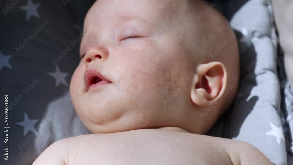 atopic dermatitis rush and allergic skin on baby infant cheek face ...