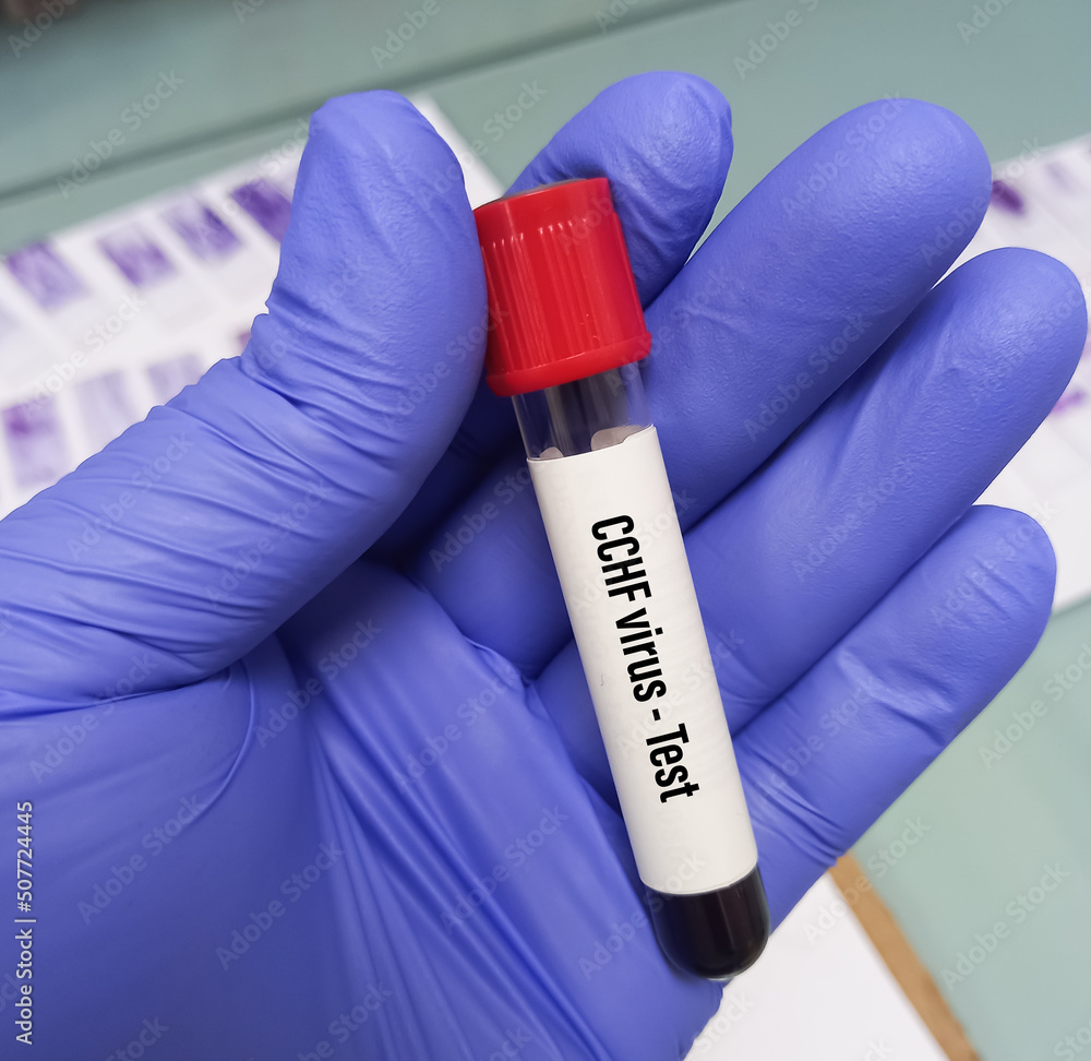 Blood sample for CCHF(Crimean Congo hemorrhagic fever) virus test ...