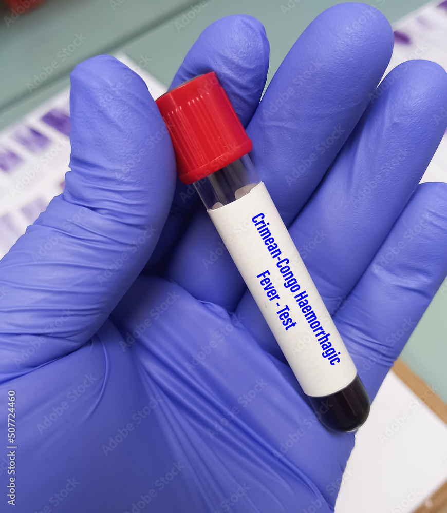 Blood sample for Crimean Congo hemorrhagic fever(CCHF) virus test ...