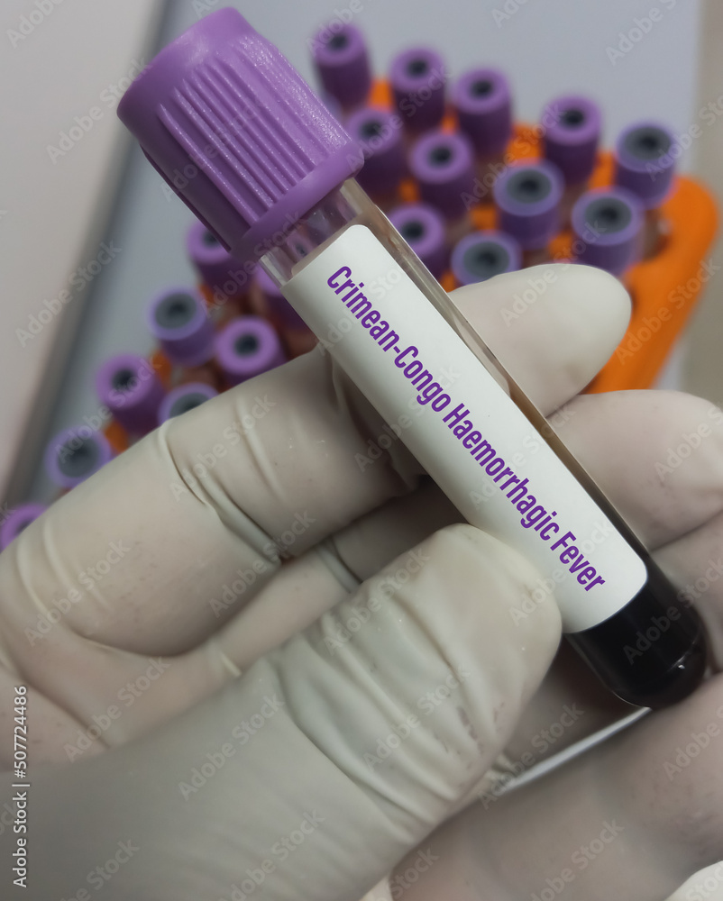 Blood sample for Crimean Congo hemorrhagic fever(CCHF) virus test ...