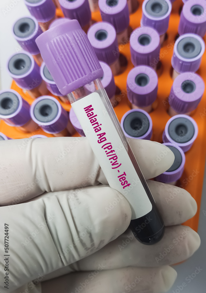 Blood test sample for Malaria Ag (Pf,Pv) test to diagnose malaria ...