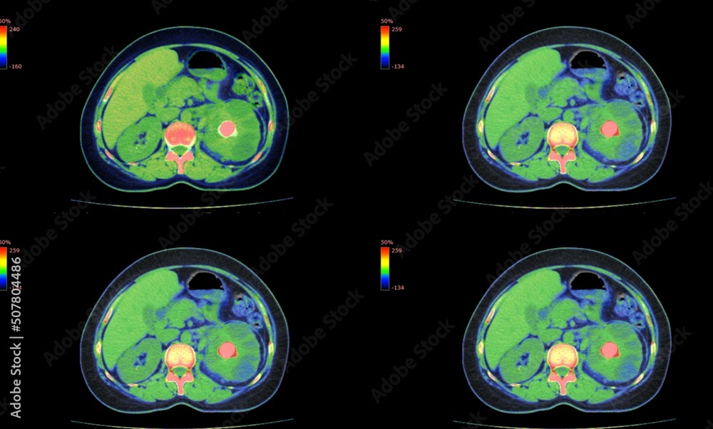 Colored axial plane abdomen ct scan of left kidney stone Stock Photo ...