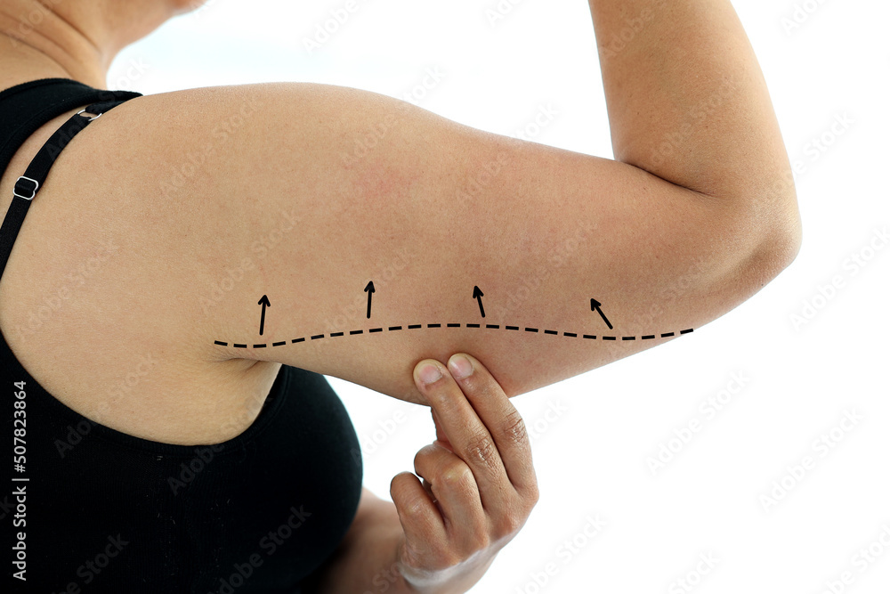 Plastic surgery doctor draw line on patient arm. Woman with excess fat ...