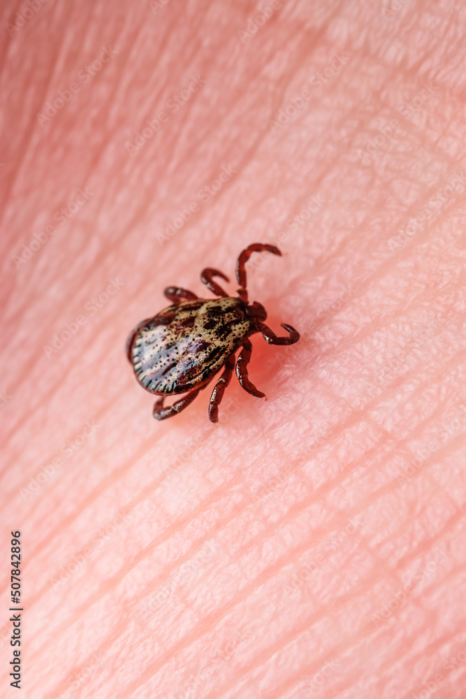 Infectious Encephalitis Tick Insect on Skin. Encephalitis Virus or Lyme ...