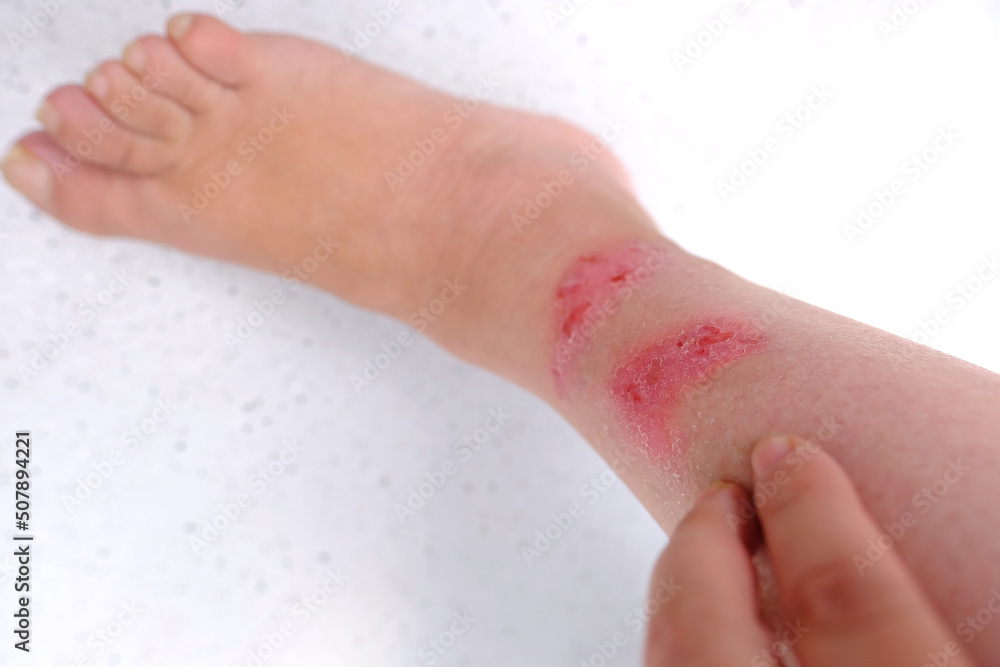 close up of female leg, healing wound from on lower leg with scars of ...