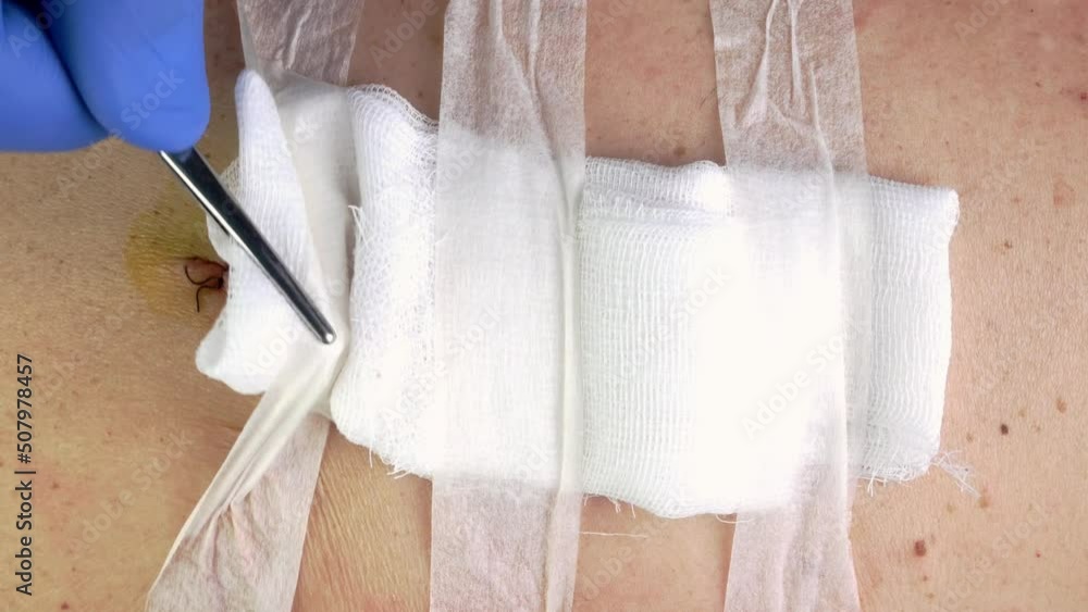 Medical sutures, stitch after surgery, stitched surgical sutures on ...