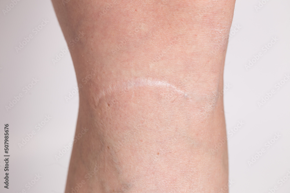 Scar on a girl's leg close-up. Varicose veins from the injury on the ...