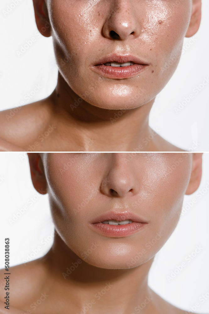 before and after excision of a nevus spots on a woman's cheek with a ...