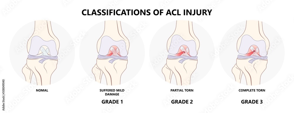 ACL injury knee tear torn Arthroscopy bone Pain swollen range of motion grade thighbone Rest Ice ...