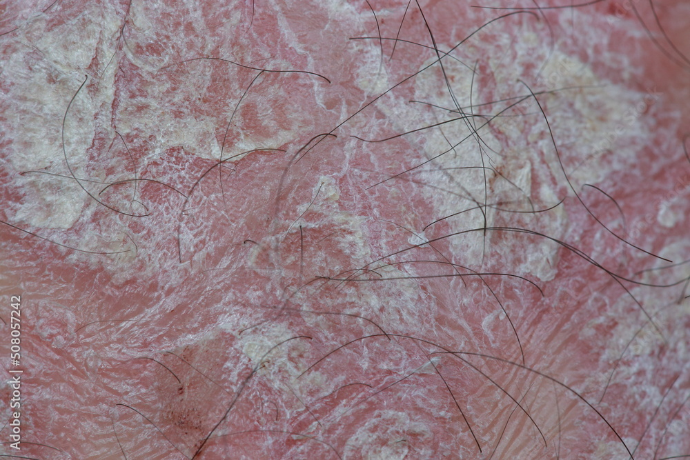 Skin Psoriasis Psoriasis is an autoimmune disease that affects the skin ...