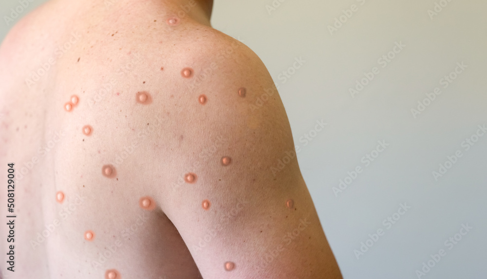 Monkeypox new disease that is dangerous to people. Man and his skin ...