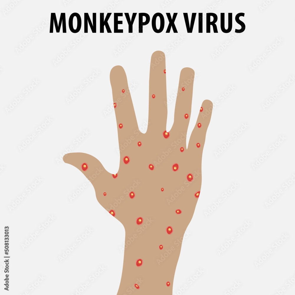 Human hand with a rash caused by monkeypox virus. one of the most ...