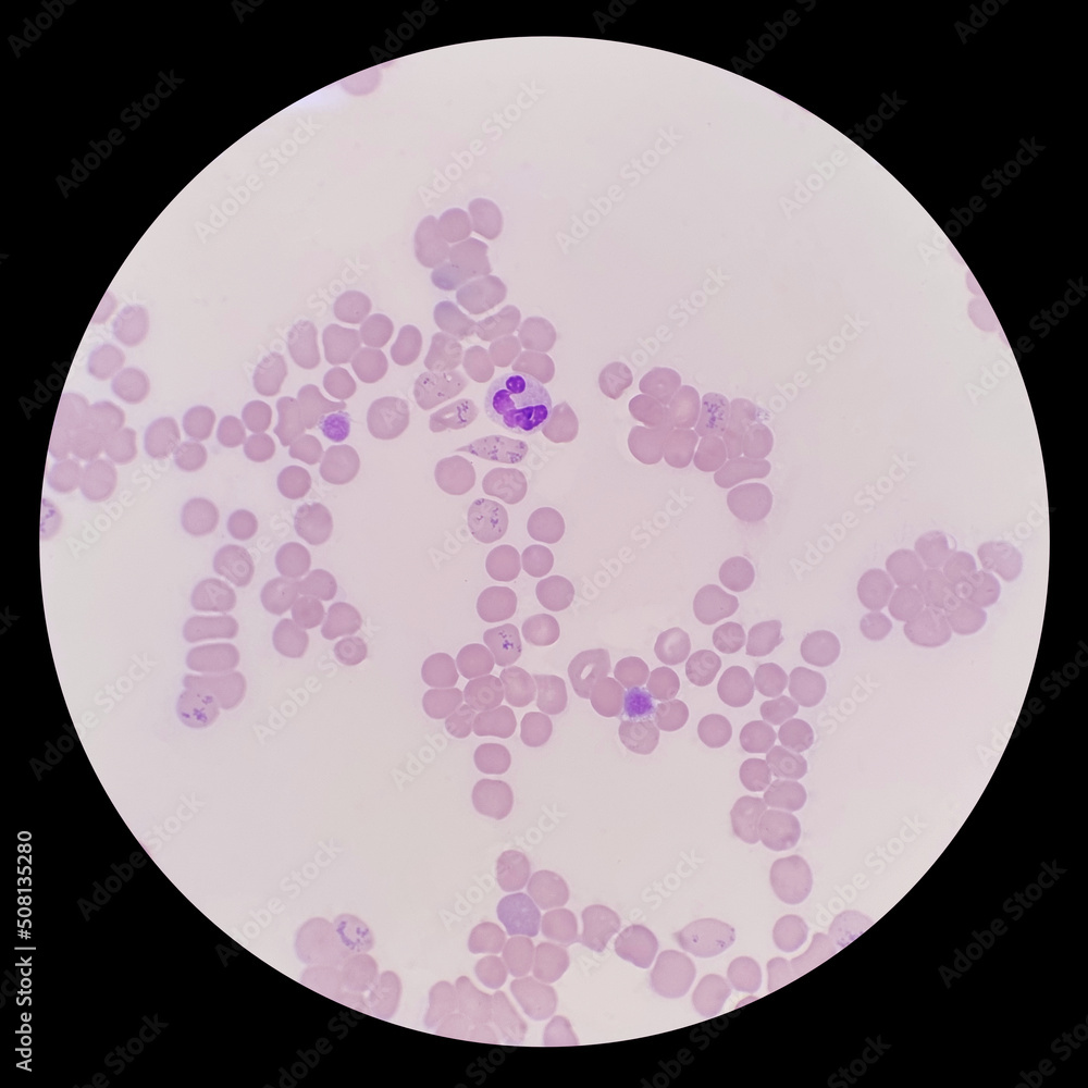 Reticulocyte count under 100x light microscope by using New methylene ...