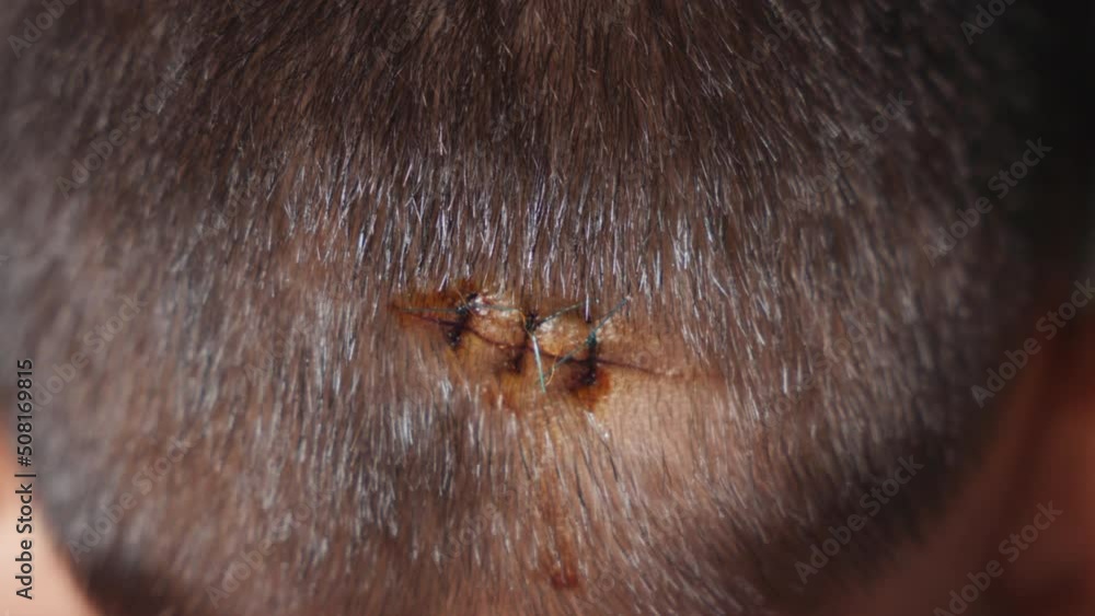 The lacerated sutured wound of kid back head which suture by nylon ...
