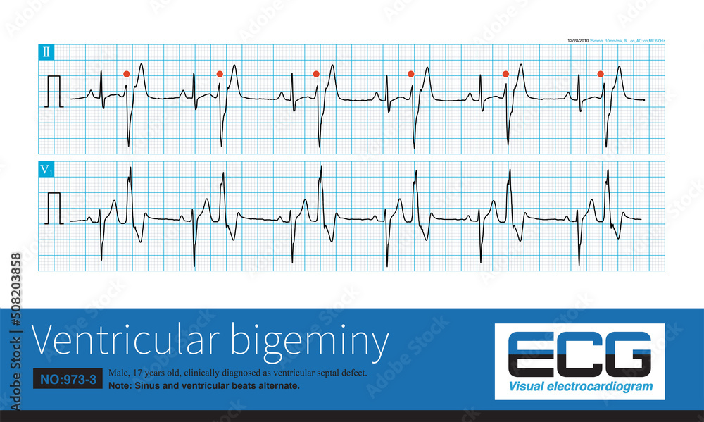 Naklejka A 17 year old male was clinically diagnosed as ventricular ...