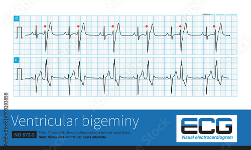 Naklejka A 17 year old male was clinically diagnosed as ventricular ...