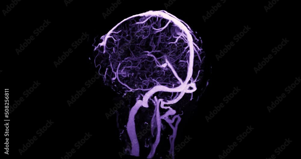 CTV Brain scan 3D rendering for diagnosis venous sinus thrombosis ...