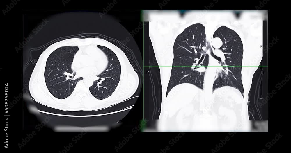 CT Chest or CT Scan of Lung axial and Coronal for diagnosis TB,tuberculosis and coronavirus or ...