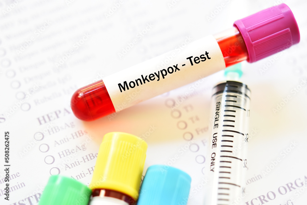 Blood sample tube for Monkeypox virus test, new epidemic disease in ...