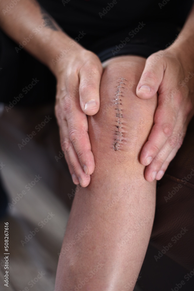 Skin closure after joint replacement surgery. Care for my wound after ...