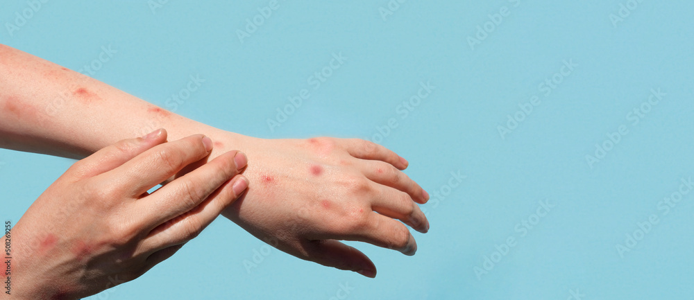 Monkeypox new disease dangerous over the world. Patient with Monkey Pox ...