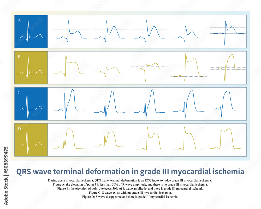Ilustração do Stock: During acute myocardial ischemia, QRS wave ...