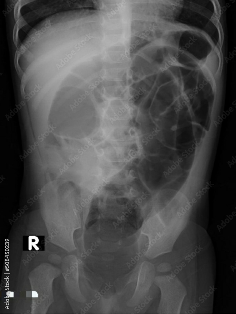 x ray image of dilatation large bowel Stock Photo | Adobe Stock