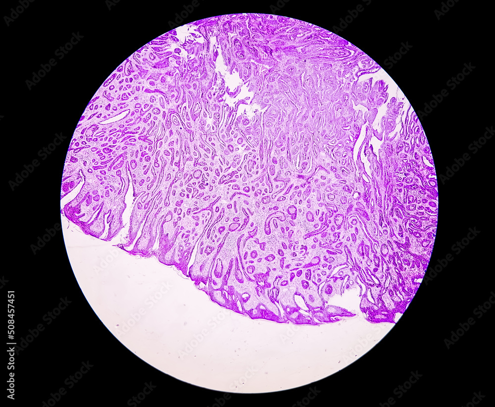 Histological slide under microscopy showing Pedunculated squamous ...