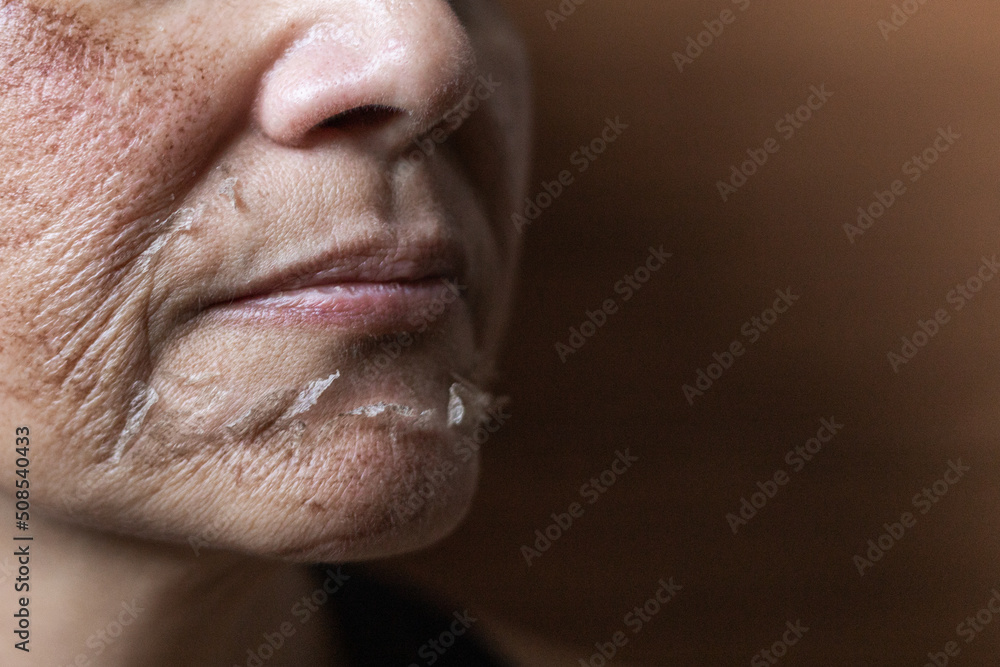 woman with chemical burns on her face after undergoing a facial peel to ...